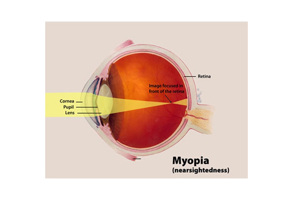 Refractive Error - Myopia