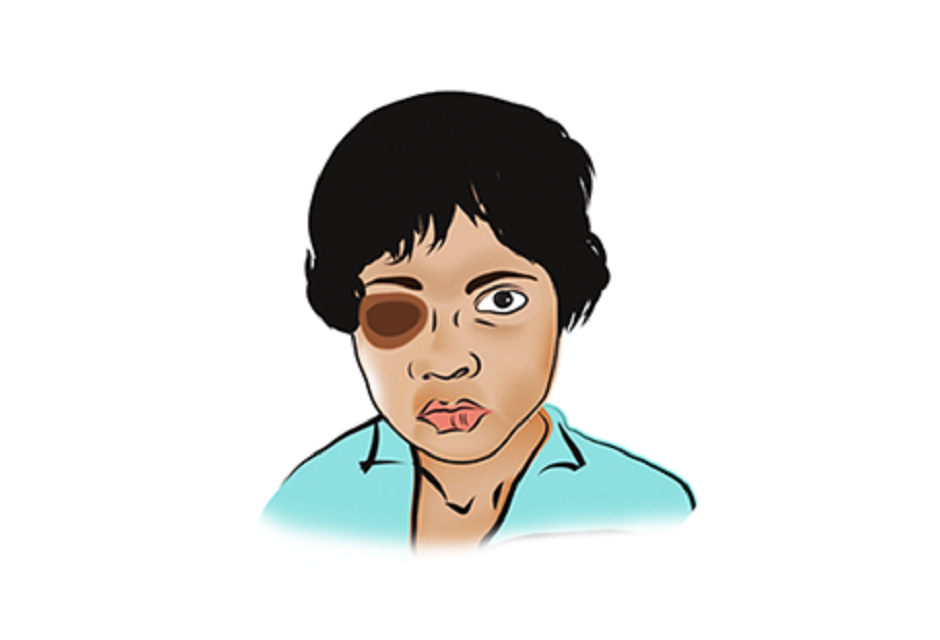 Counselling for Amblyopia